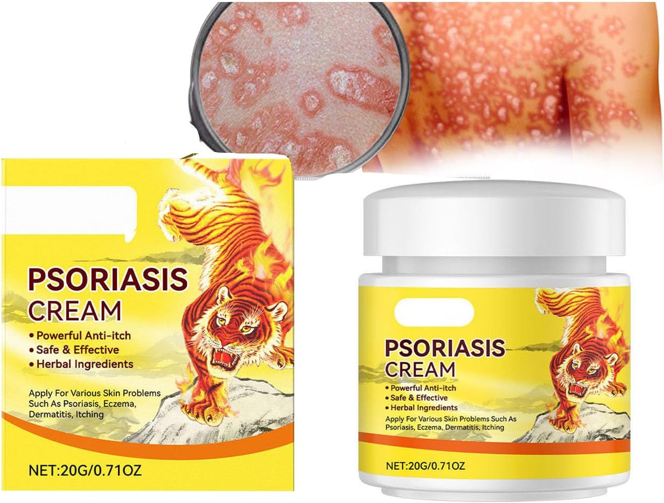 Psoriasis Cream – EZEE-Cart.COM